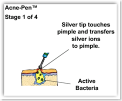 The Acne Pen....Stops Pimples in their tracks... - Medical Quack